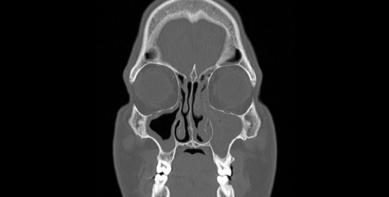 Chronic sinusitis – imaging your sinuses - Dr Jeeve ENT Specialist